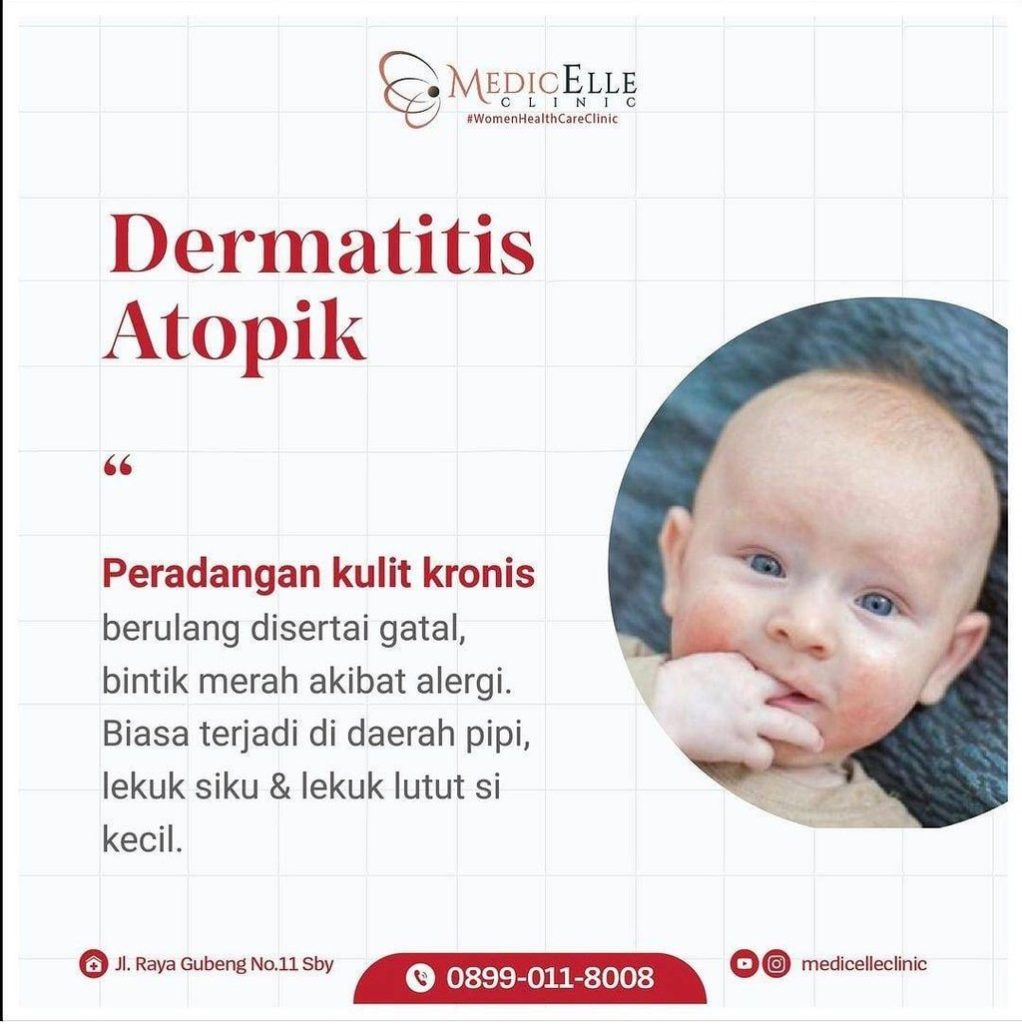 Kulit Merah dan Gatal Berulang Pada Anak Bisa Jadi Eksim, Menularkah ...